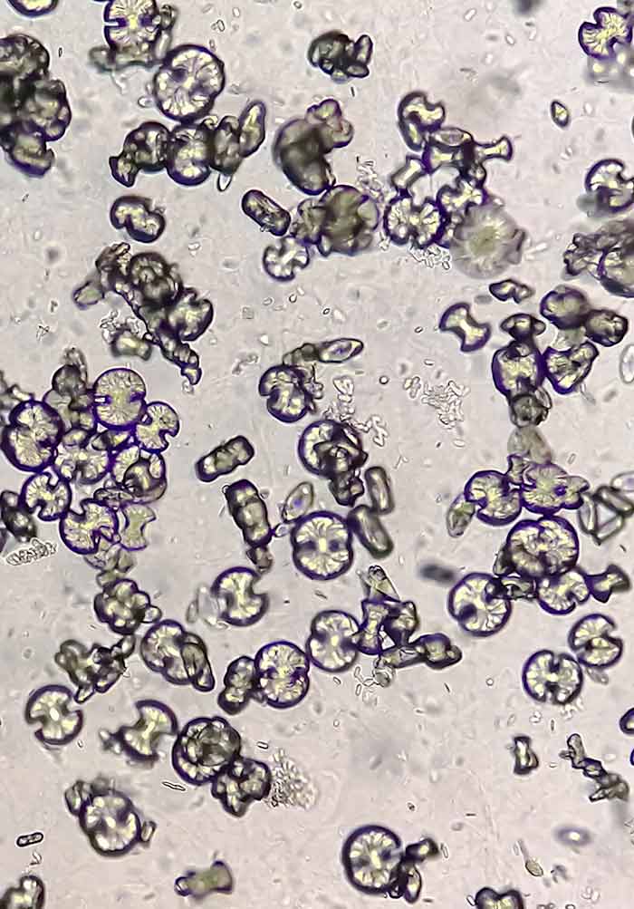 Calcium Carbonate In Urine